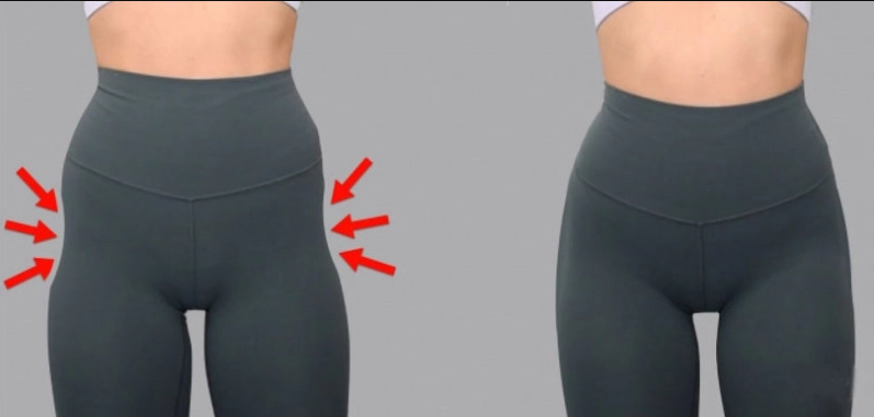 Hip Dips Filler (Hip Dips Augmentation) in iran - iranmedicaltours